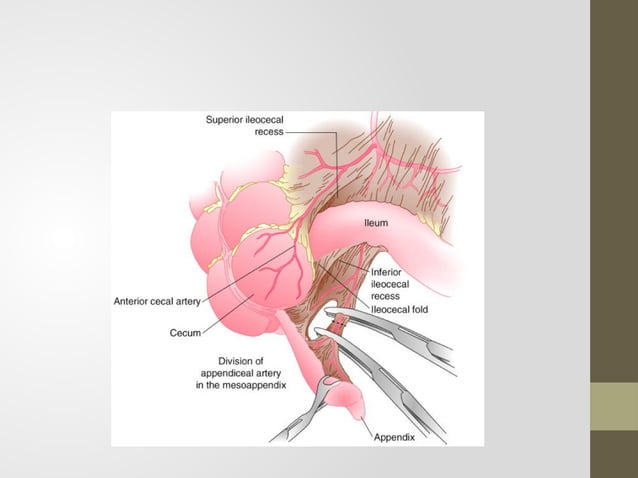 APPENDICITIS.pptxJJJJJJJJJJJJJJJJJJJJJJJJJJJJ | PPT