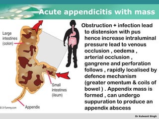 A P P E N D I C I T I S | PPT