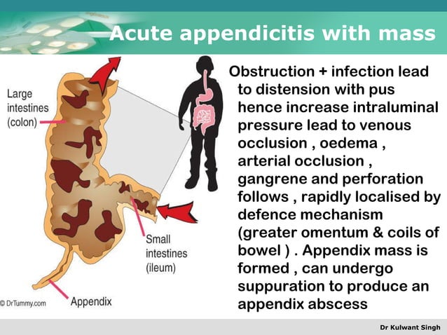 A P P E N D I C I T I S | PPT | Digestive Disorders | Diseases and ...