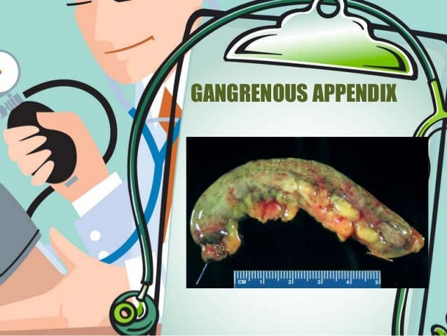 Appendicitis- a simplistic view for GPs
