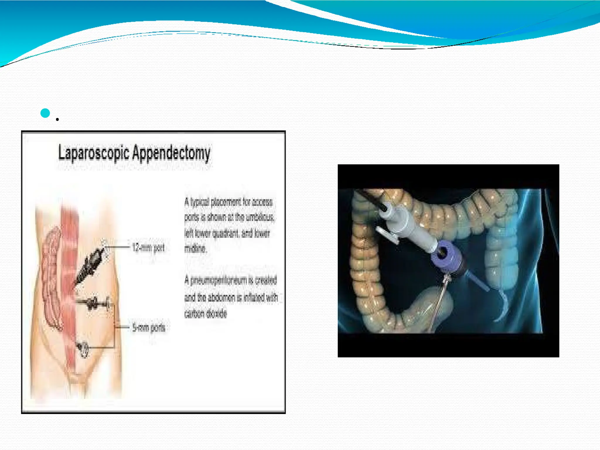 APPENDICITIS 2.pptx7777777777777777777777777777777777 | PPT