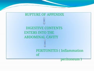 APPENDICITIS 2.pptx7777777777777777777777777777777777 | PPT