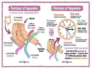 APPENDICITIS 2.pptx7777777777777777777777777777777777 | PPT