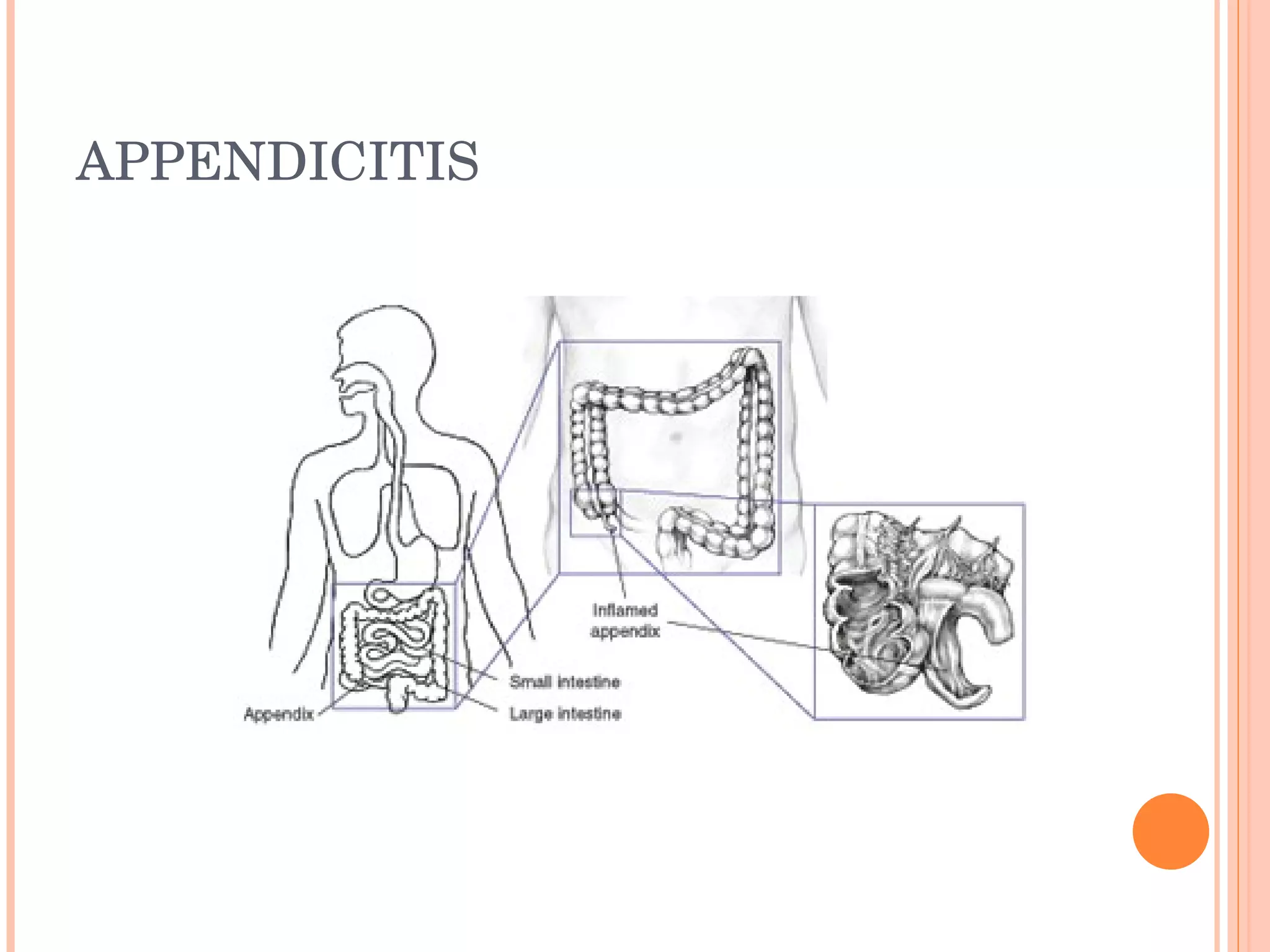 Appendicitis | PPT
