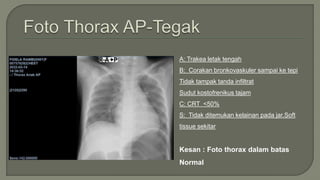 Appendicitis Anak.pptx