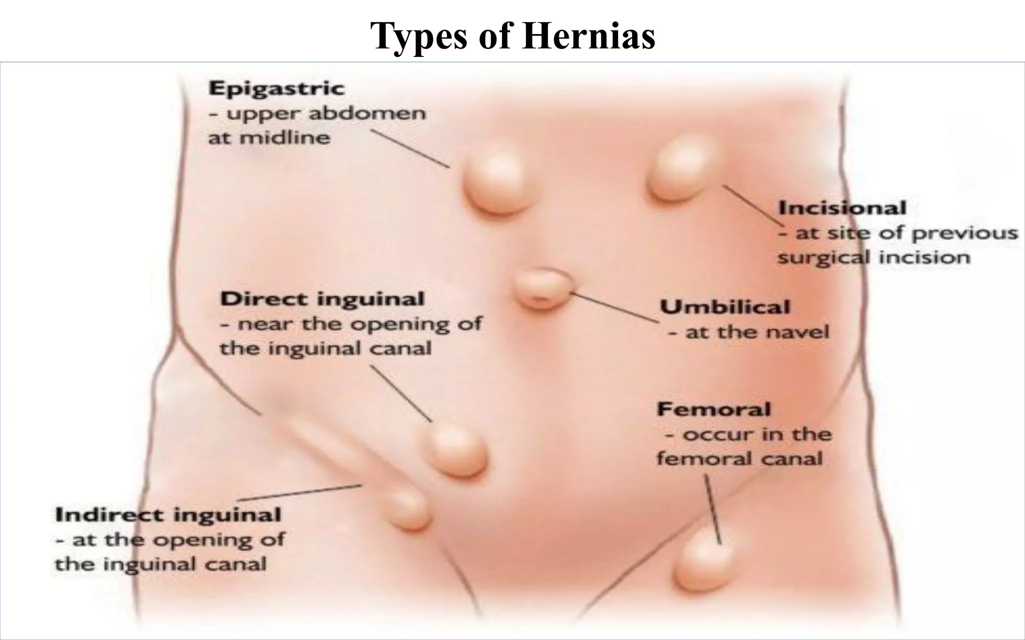 Appendicitis and hernia | PDF