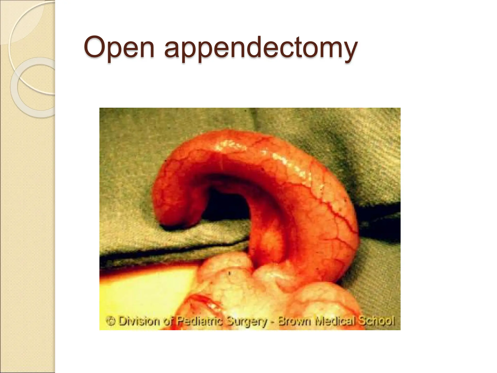 APPENDICITIS clinical sign symptoms and Management.ppt