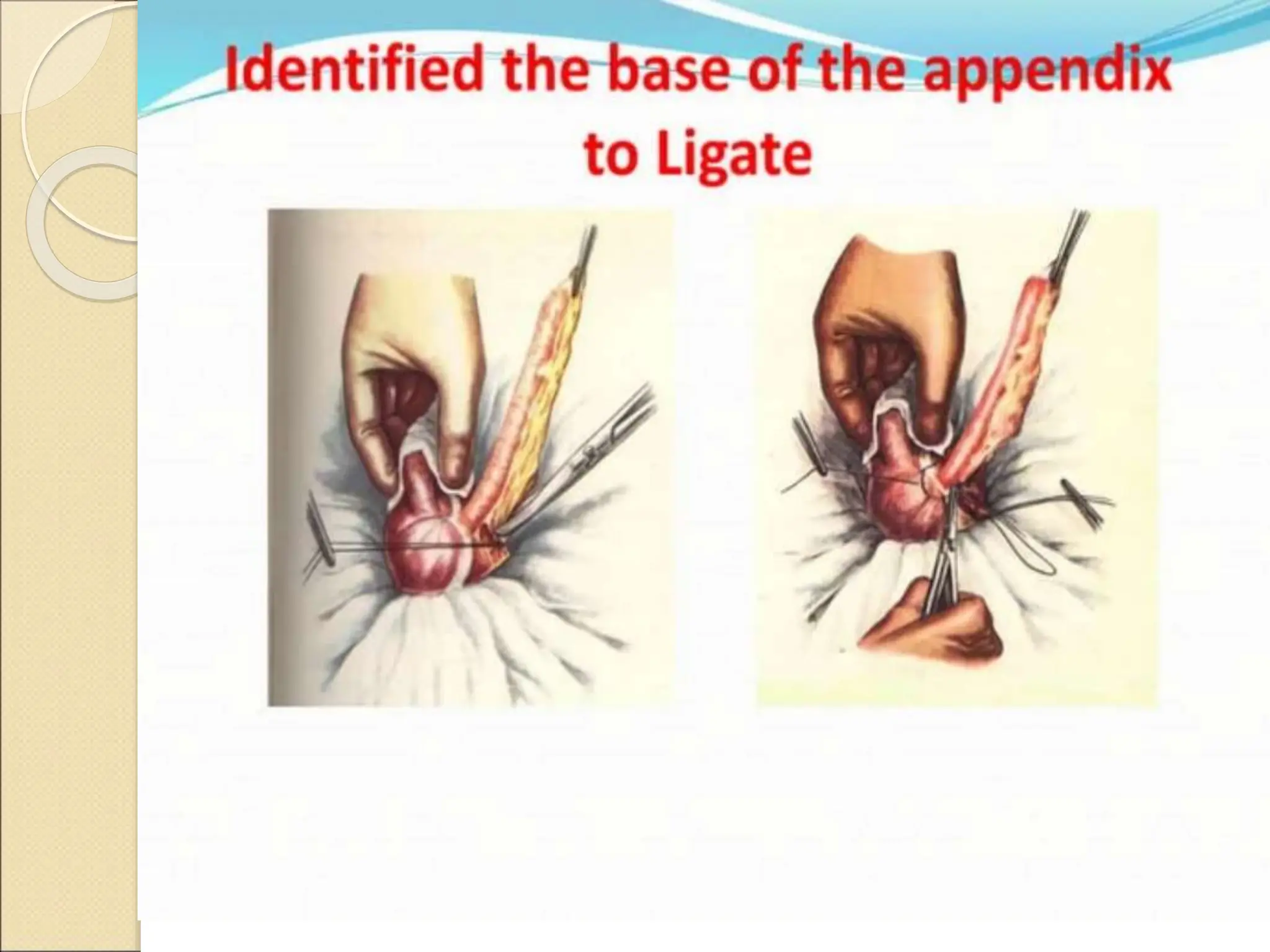 APPENDICITIS clinical sign symptoms and Management.ppt