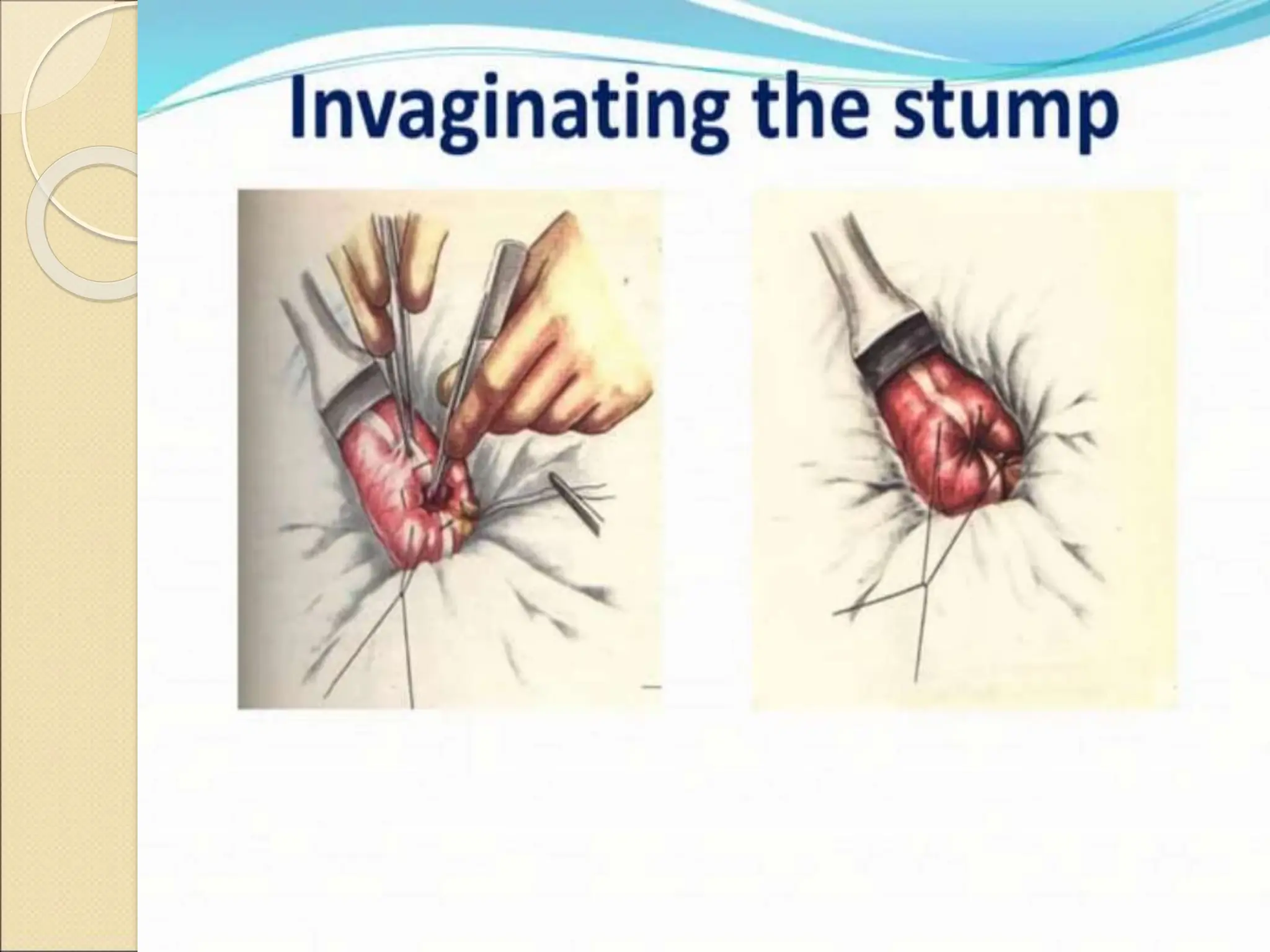 APPENDICITIS clinical sign symptoms and Management.ppt