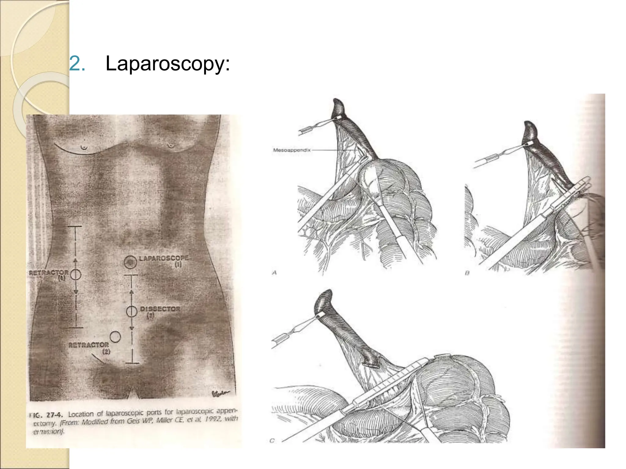 APPENDICITIS clinical sign symptoms and Management.ppt