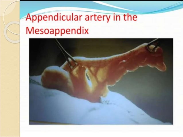 APPENDICITIS clinical sign symptoms and Management.ppt