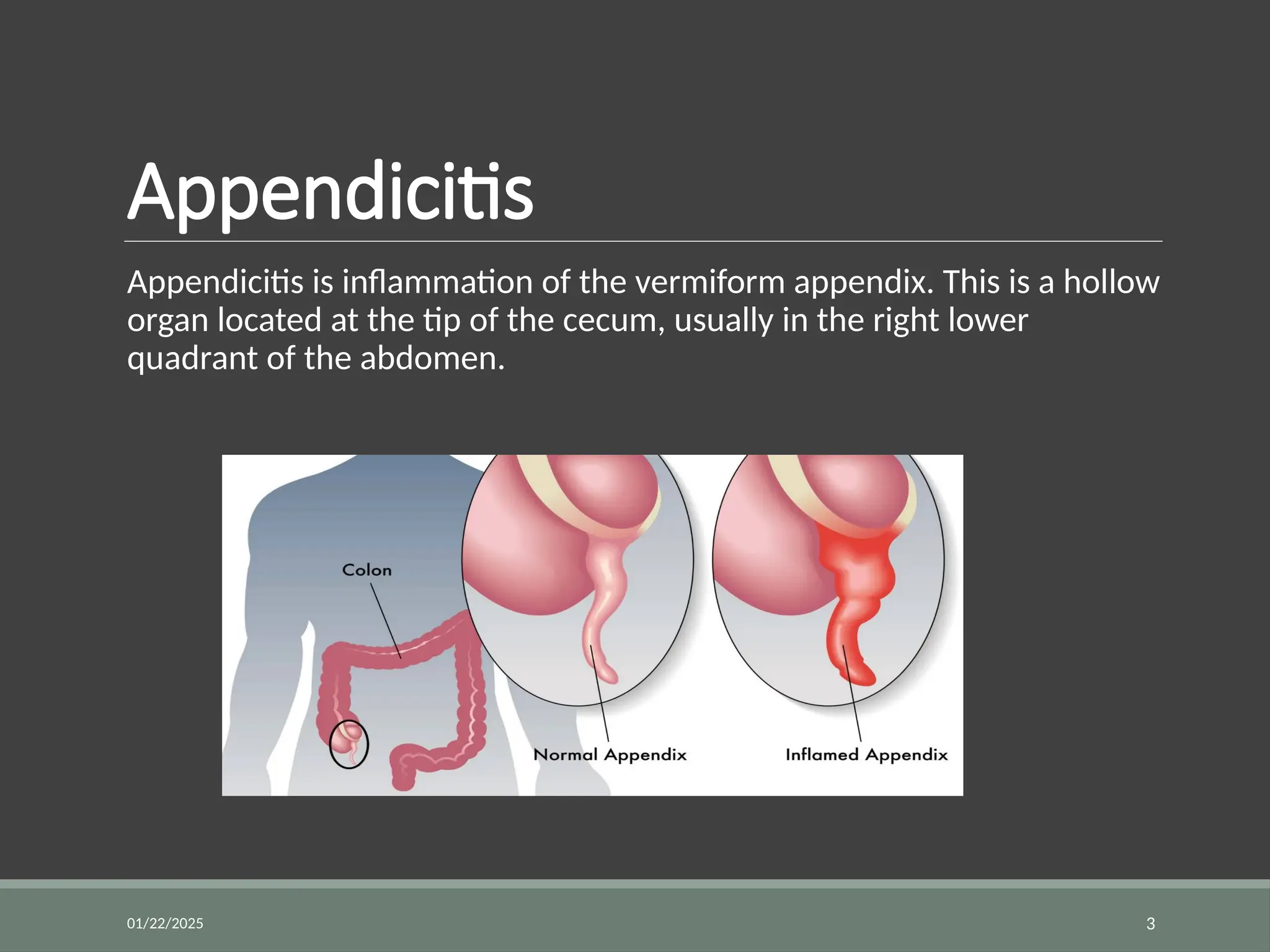 Appendicitis and peritonitis 2019 (1).pptx