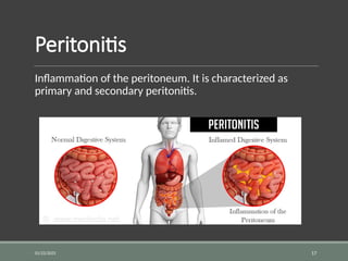 Appendicitis and peritonitis 2019 (1).pptx