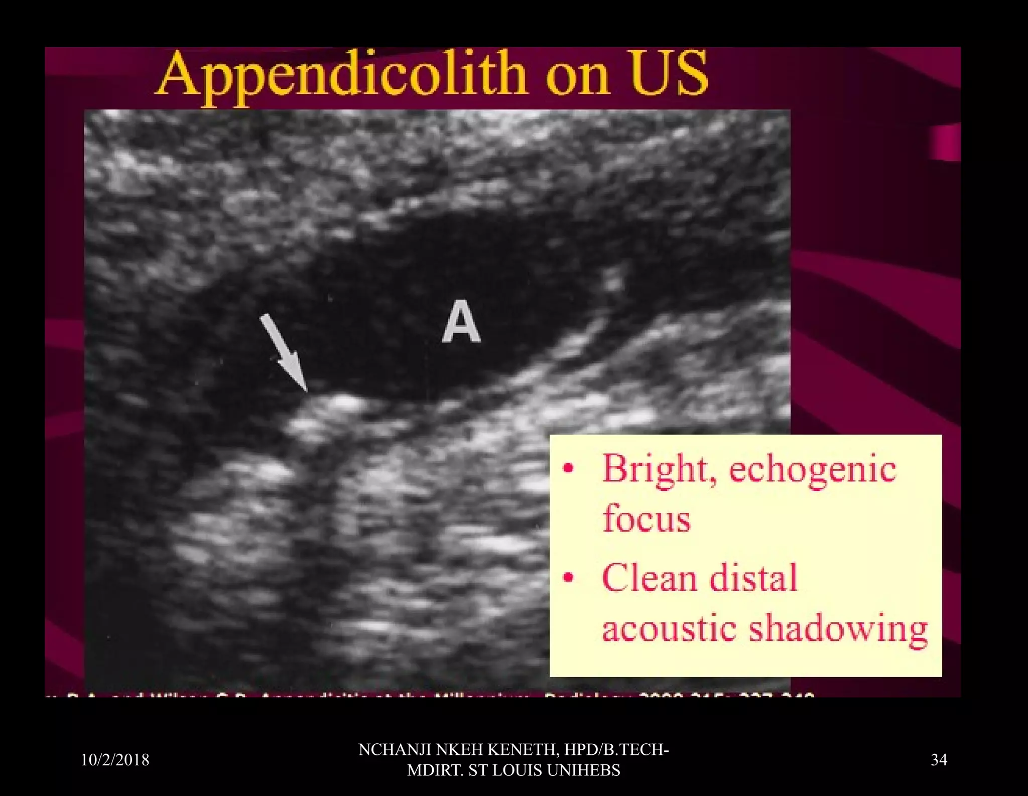 Appendicitis and role of ultrasound scan in diagnosis Nchanji Nkeh ...
