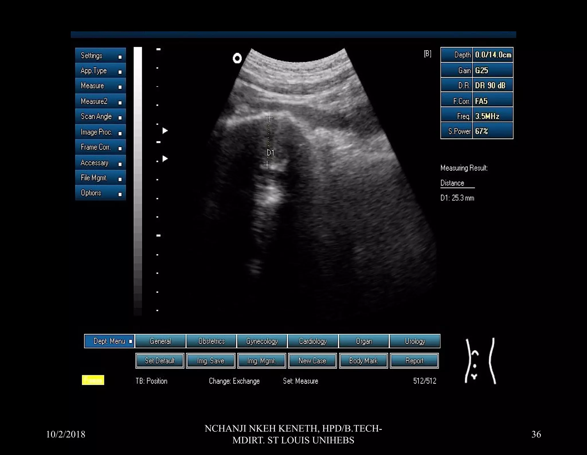 Appendicitis and role of ultrasound scan in diagnosis Nchanji Nkeh ...