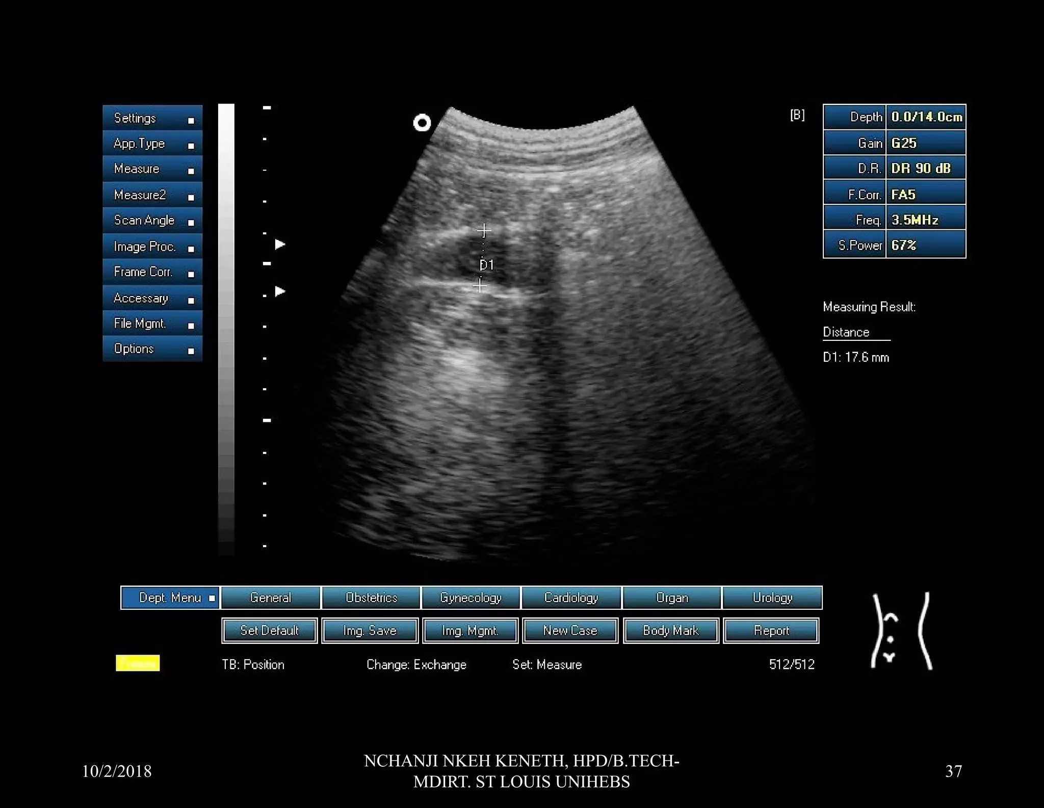 Appendicitis and role of ultrasound scan in diagnosis Nchanji Nkeh ...