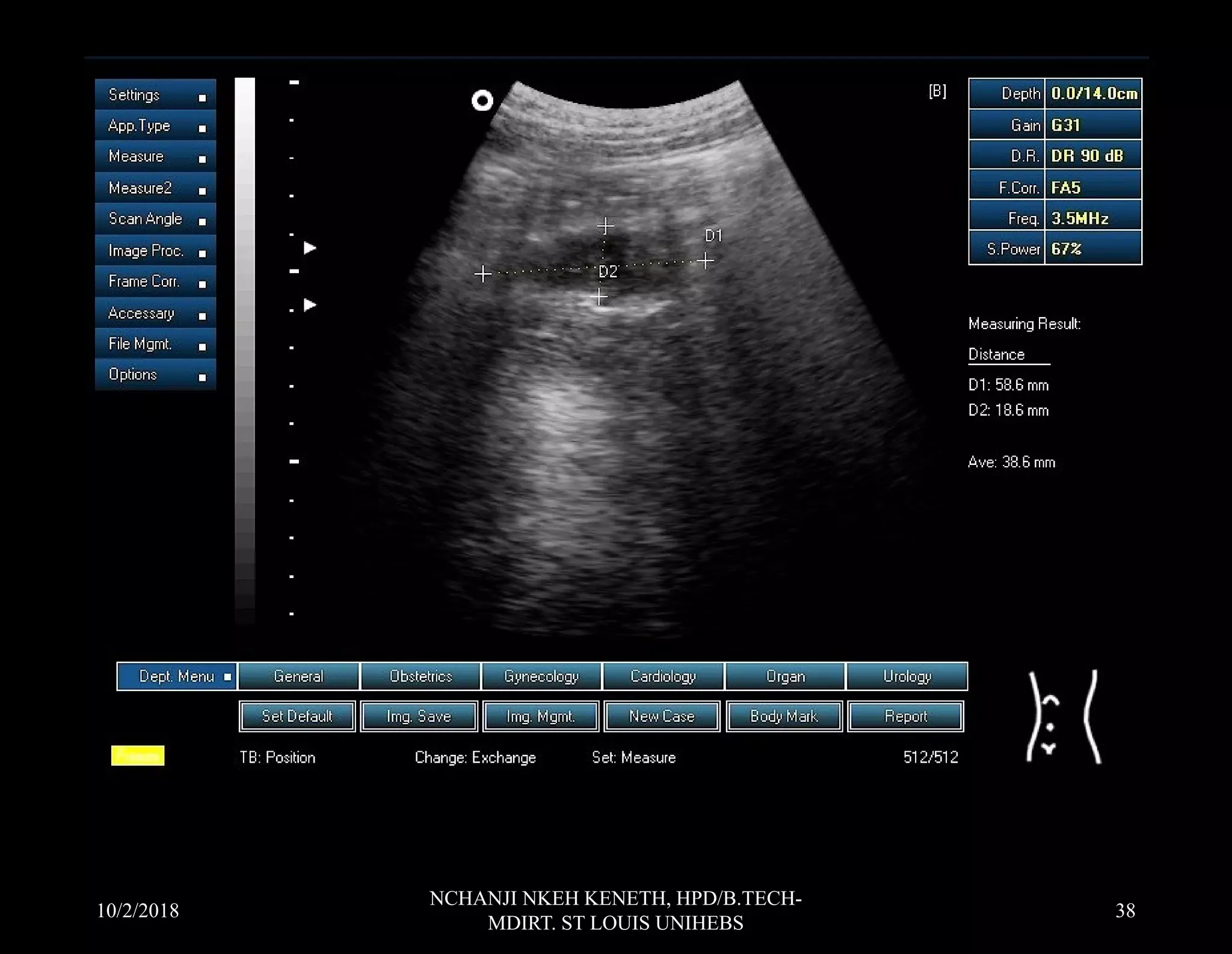 Appendicitis and role of ultrasound scan in diagnosis Nchanji Nkeh ...