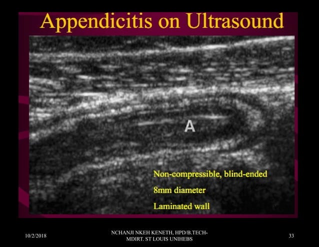Appendicitis and role of ultrasound scan in diagnosis Nchanji Nkeh ...