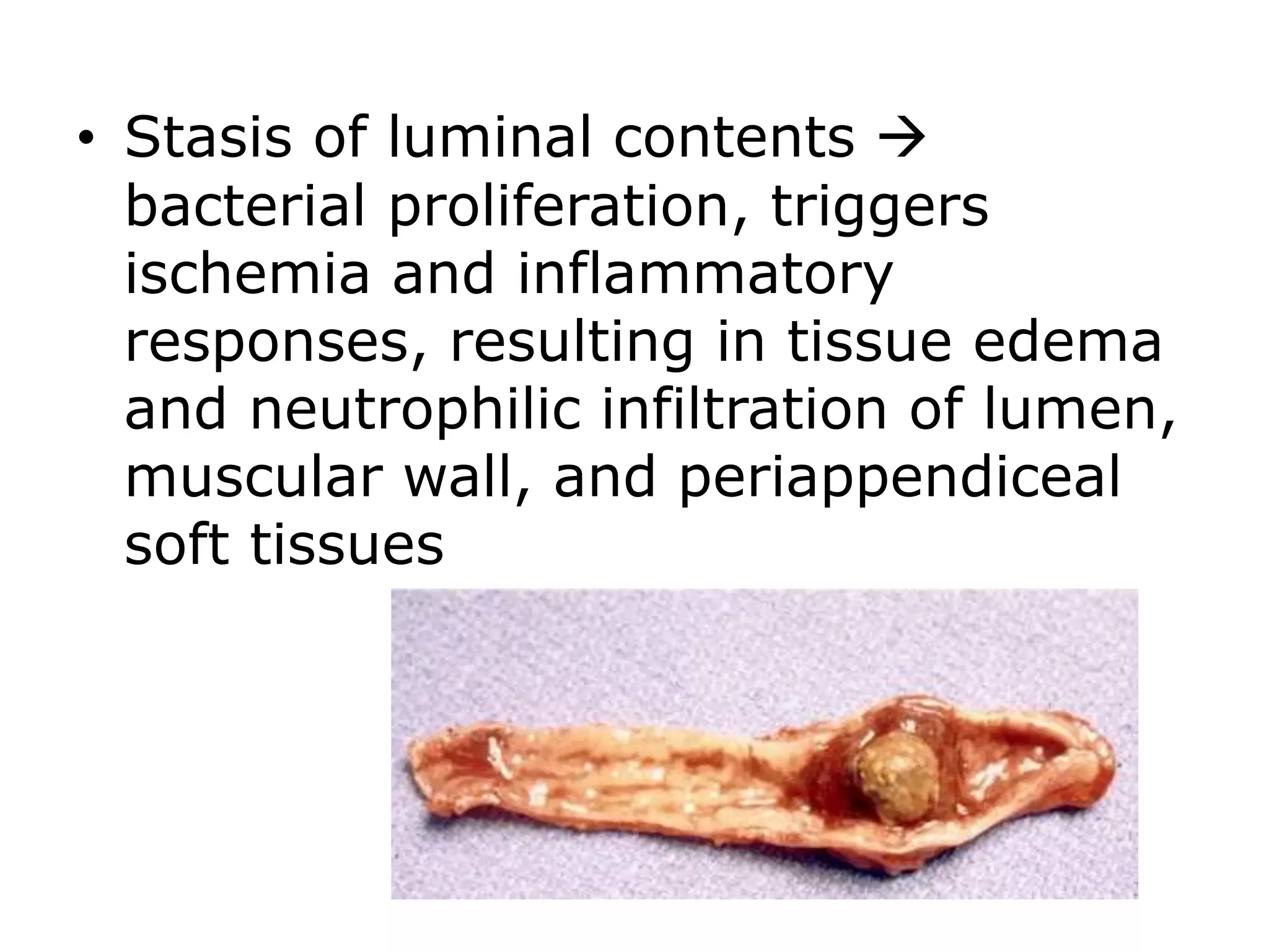 Appendicitis and tumors of appendix mbbs | PPTX