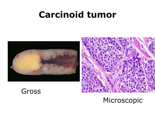 Appendicitis and tumors of appendix mbbs | PPTX | Digestive Disorders ...