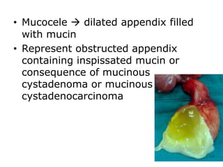 Appendicitis and tumors of appendix mbbs | PPTX