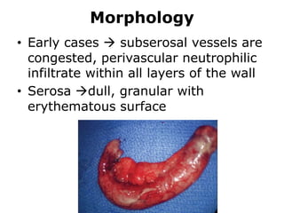 Appendicitis and tumors of appendix mbbs | PPTX