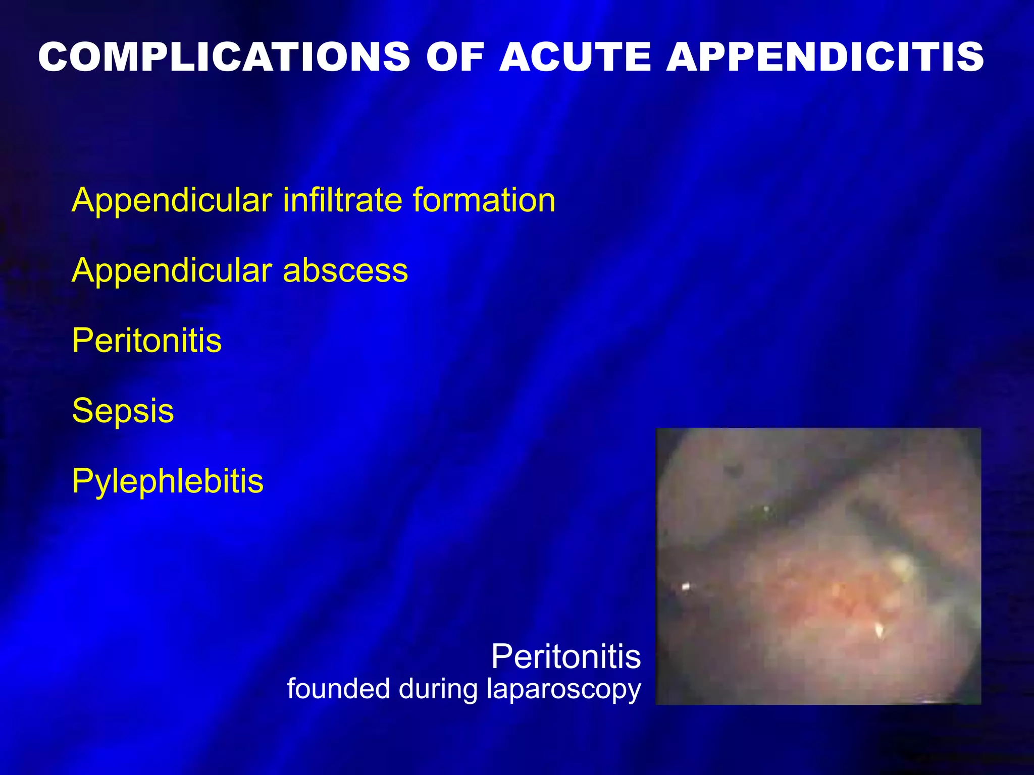 Appendicitis DELV.ppt