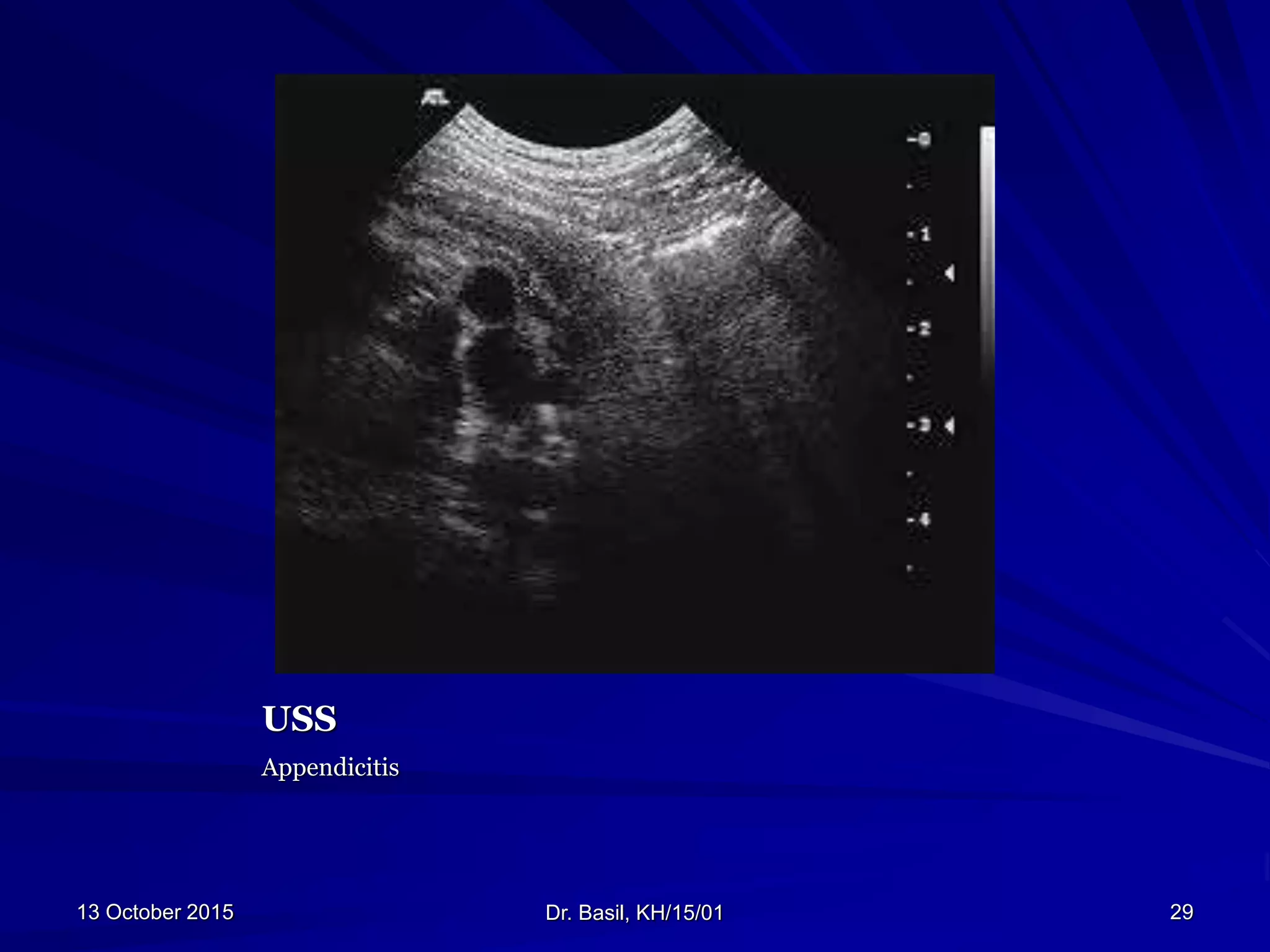 Appendicitis dr. basil tumaini | PPTX | Digestive Disorders | Diseases ...