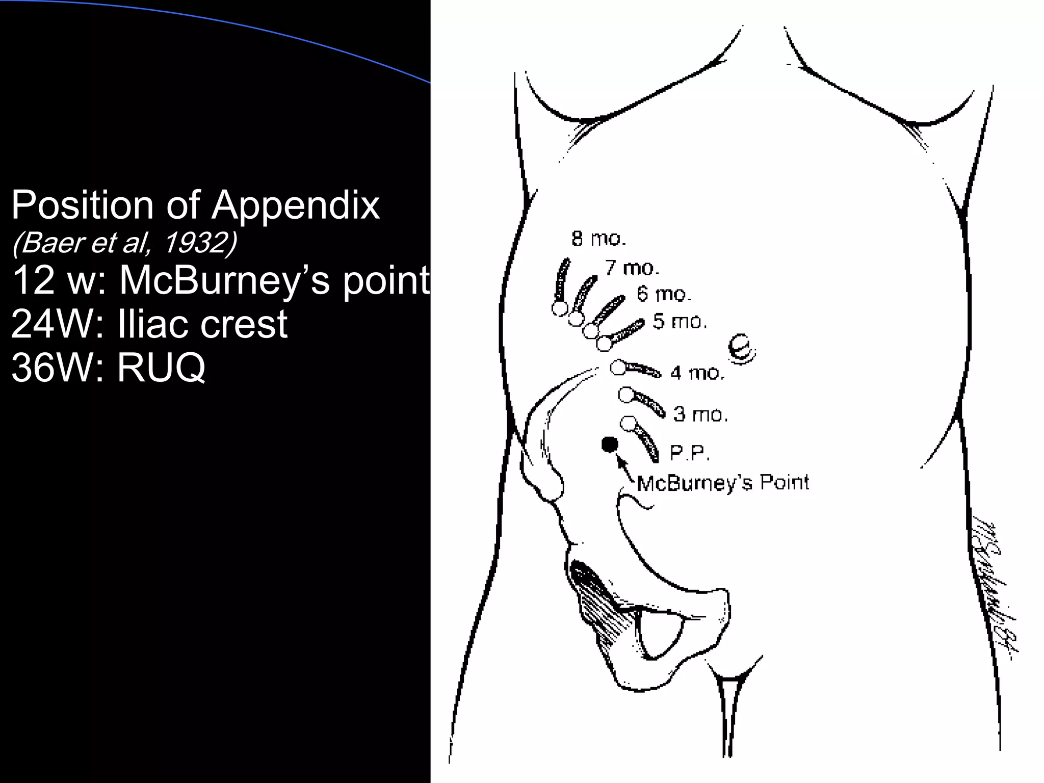 Appendicitis during pregnancy | PDF