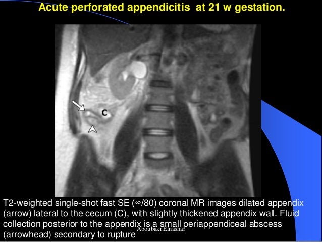 Appendicitis during pregnancy