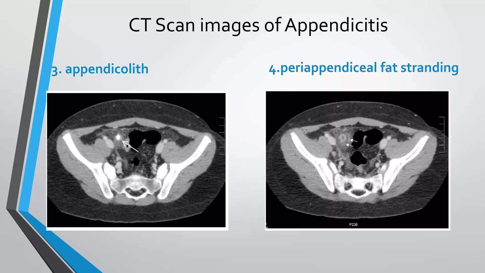 Appendicitis, diverticulitis, peptic ulcer disease, chron's disease | PPT