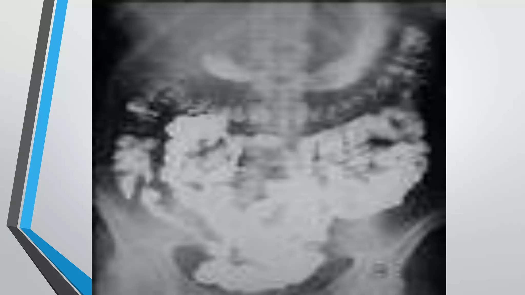 Appendicitis, diverticulitis, peptic ulcer disease, chron's disease | PPT