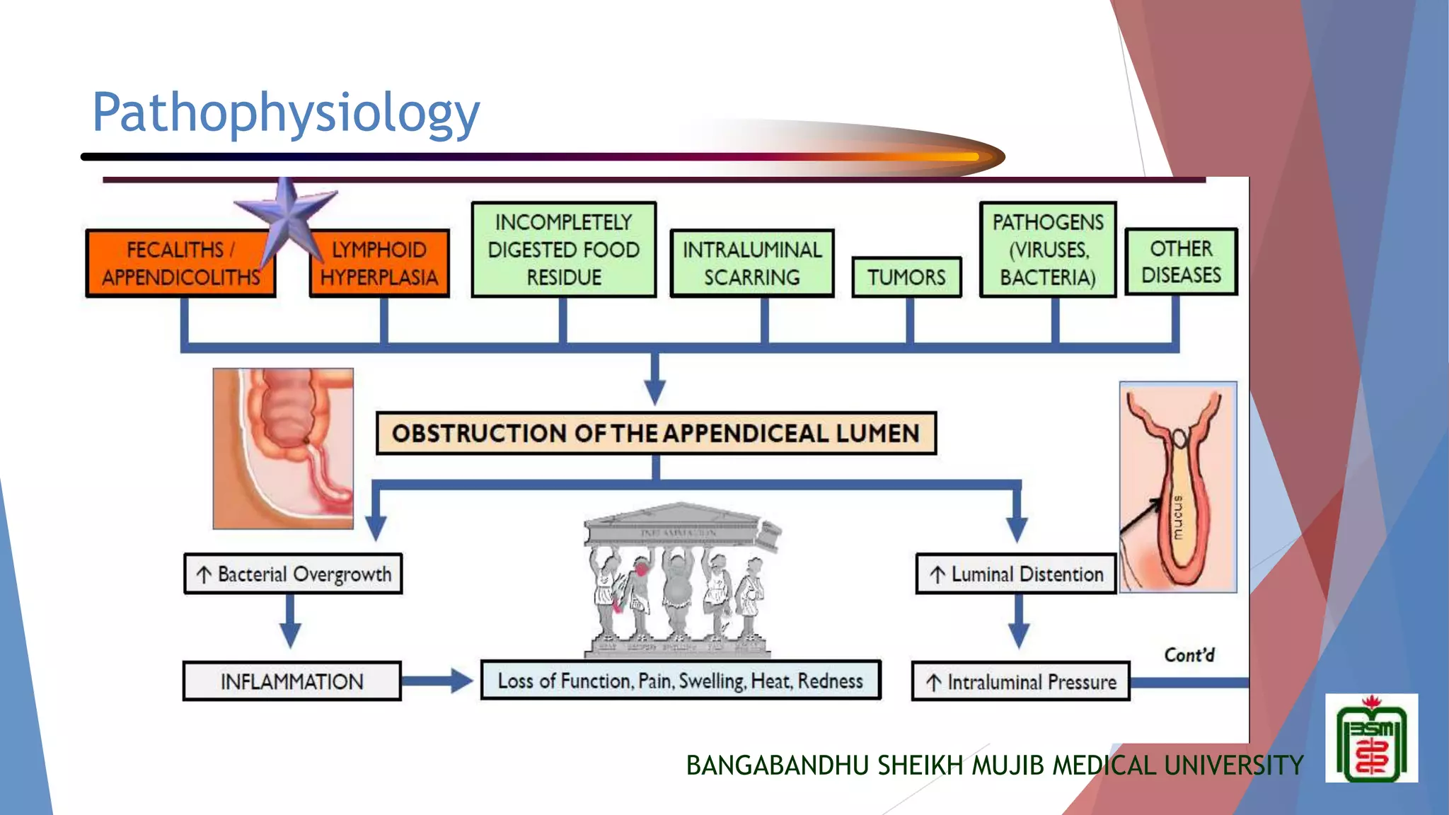 Appendicitis in children | PPTX