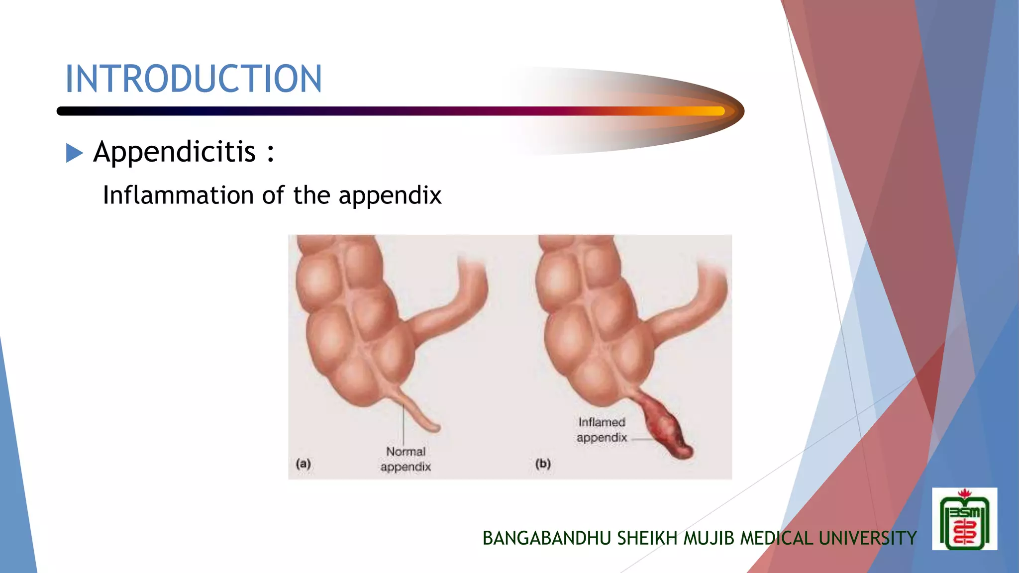 Appendicitis in children | PPTX