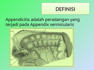 Appendicitis perforated presentation medical.pptx