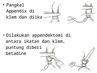 Appendicitis perforated presentation medical.pptx