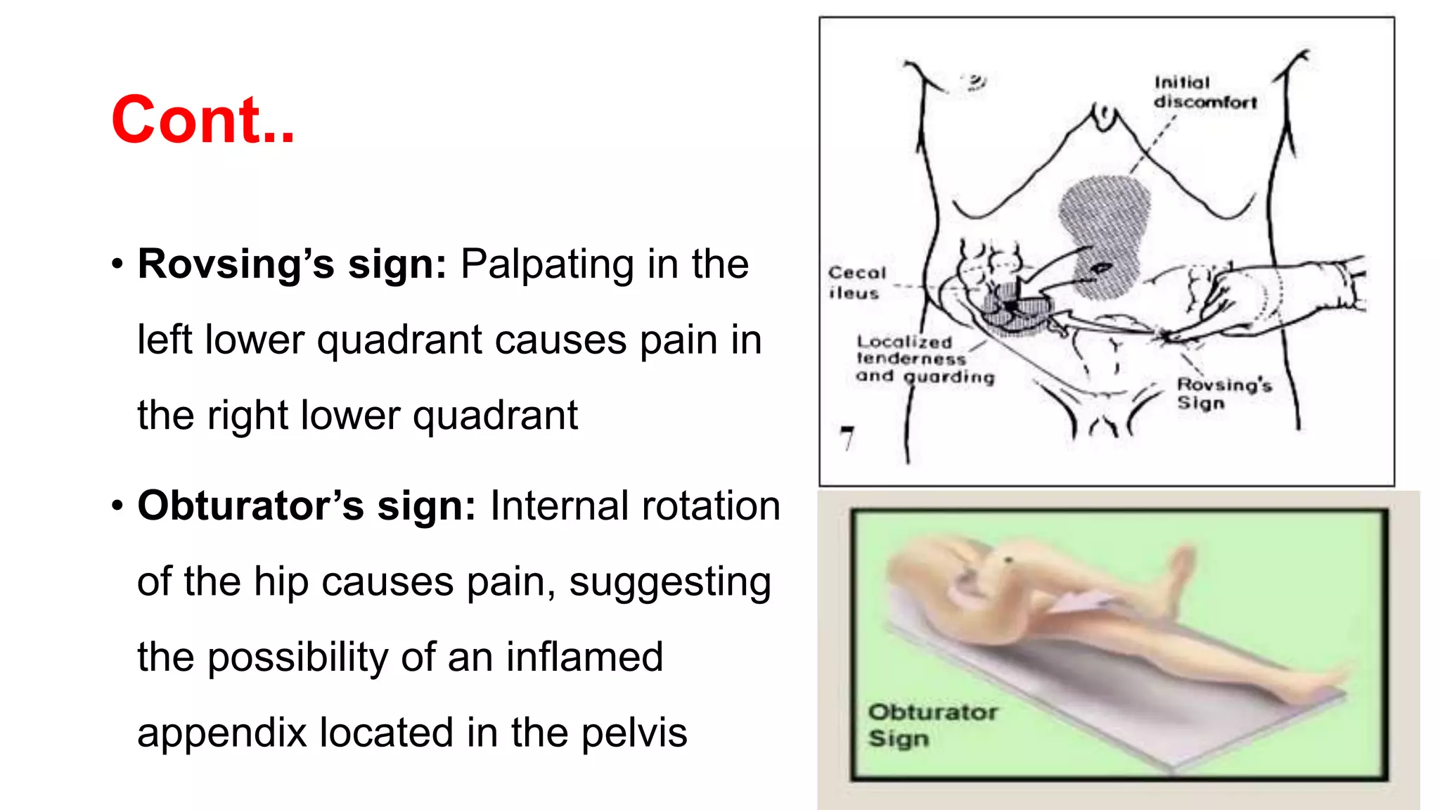 Appendicitis | PPTX