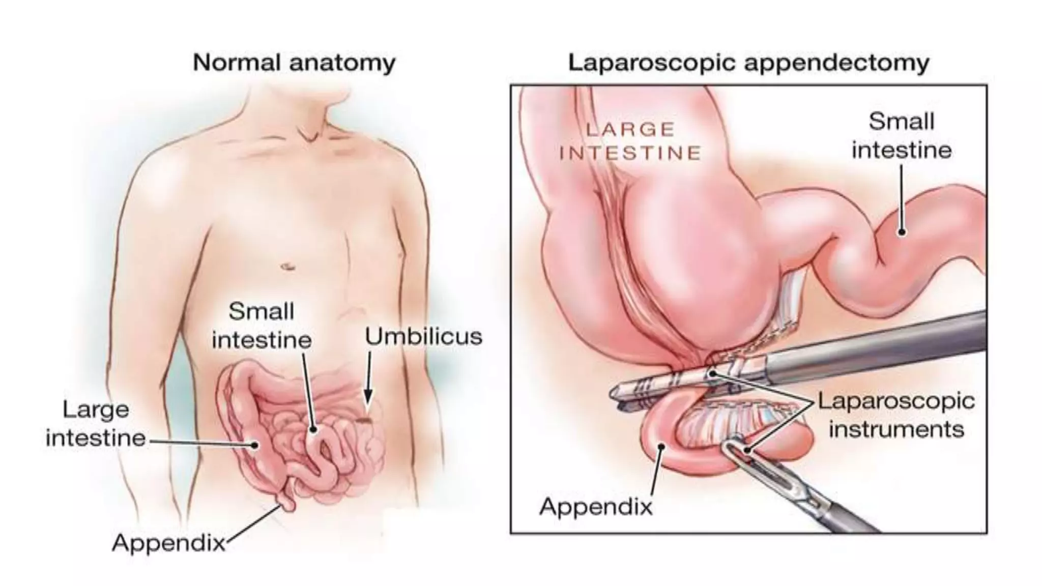 Appendicitis | PPTX