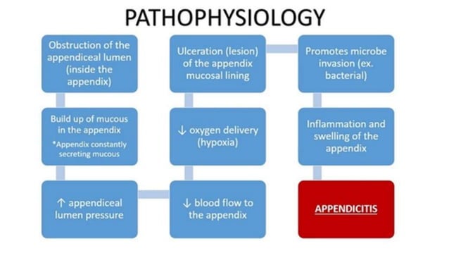 Appendicitis | PPTX