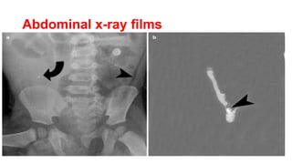 Appendicitis | PPTX