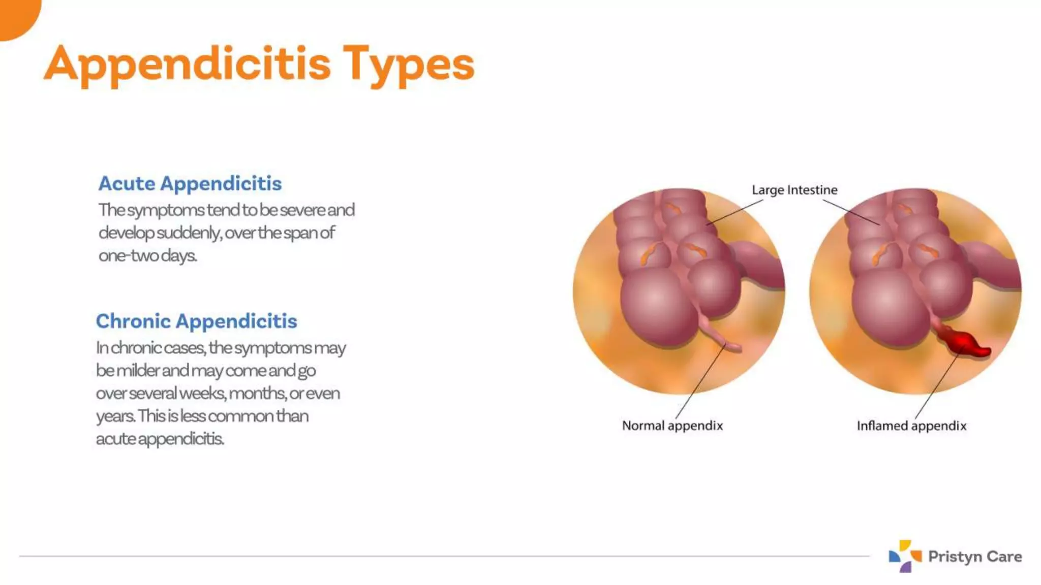 Appendicitis - Causes, Symptoms & Treatment | PPT