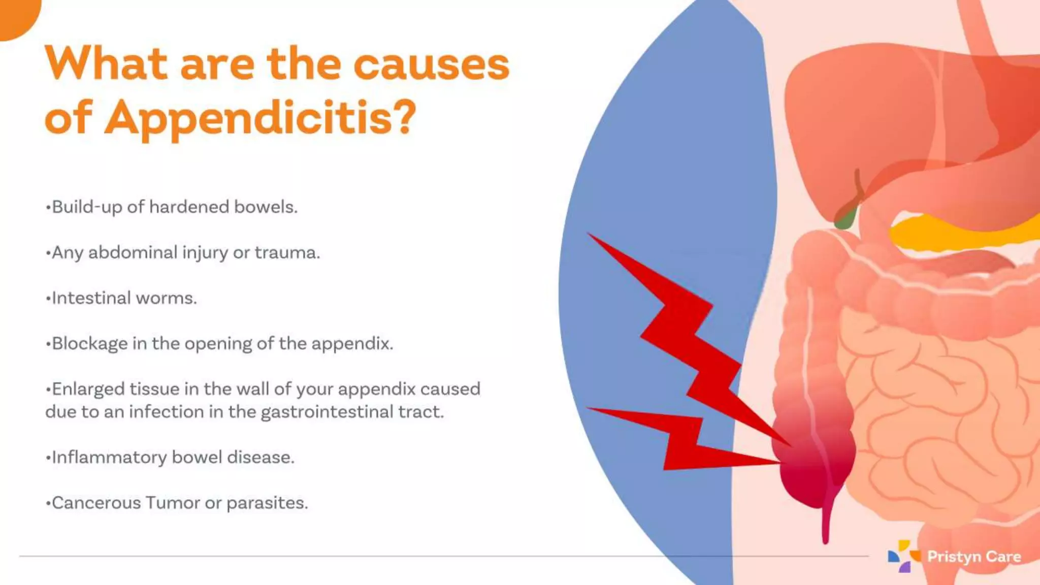 Appendicitis - Causes, Symptoms & Treatment | PPT