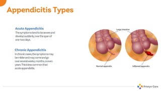 Appendicitis - Causes, Symptoms & Treatment | PPTX