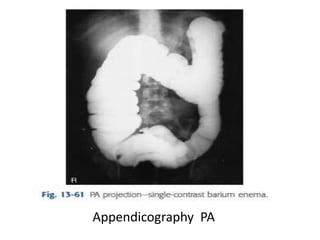 ppt kritisi dan evaluasi radiograf Appendicografi | PPTX