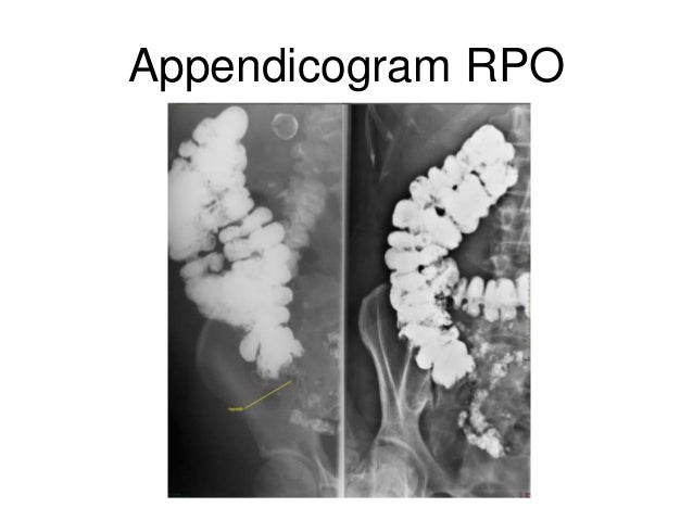 ppt kritisi dan evaluasi radiograf Appendicografi