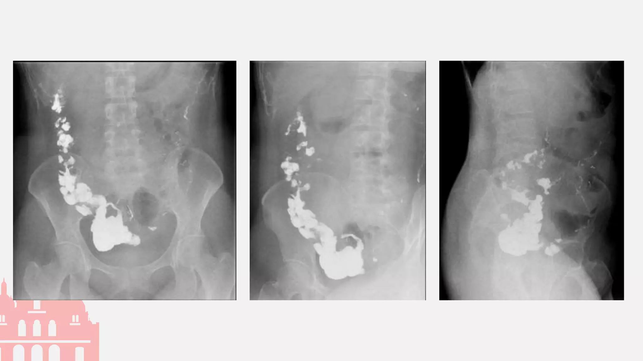 Appendicogram - Kontras - LOV TIA WIS.pptx
