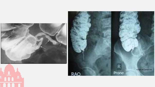 Appendicogram - Kontras - LOV TIA WIS.pptx