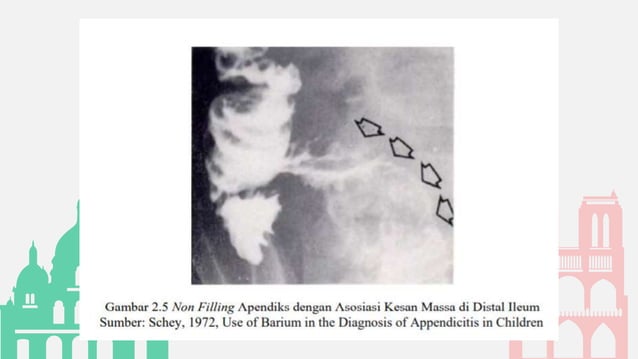Appendicogram - Kontras - LOV TIA WIS.pptx