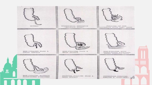 Appendicogram - Kontras - LOV TIA WIS.pptx