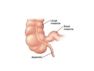 Appendiceitis, Appendecular mass and appendicular diseases .pptx